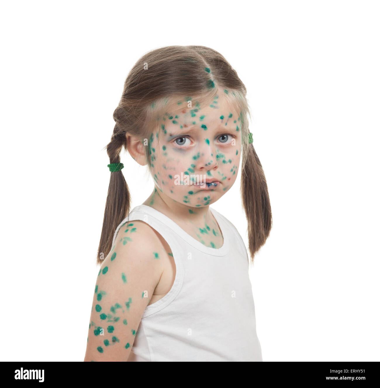 sick child. chickenpox. isolated Stock Photo - Alamy