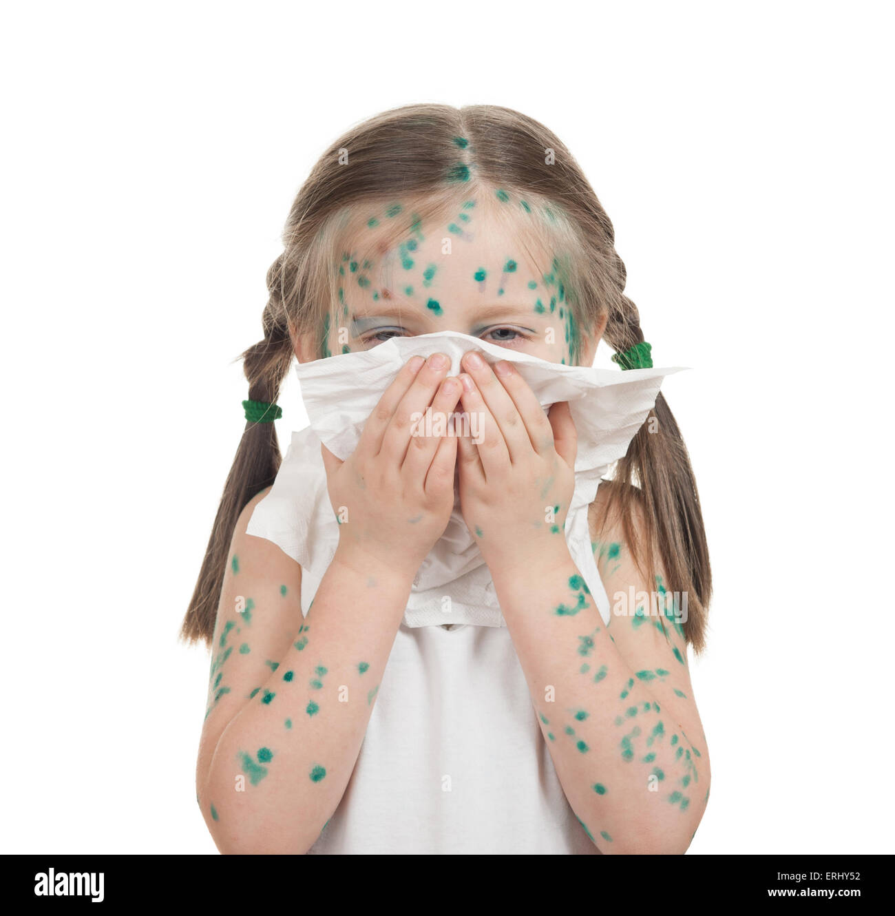 sick child. chickenpox. isolated Stock Photo - Alamy