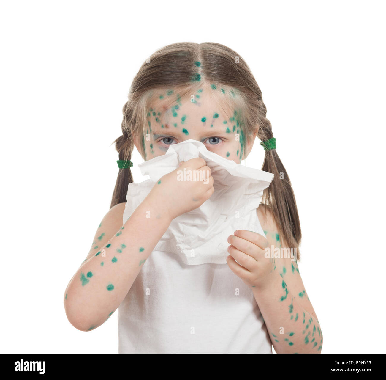 sick child. chickenpox. isolated Stock Photo - Alamy