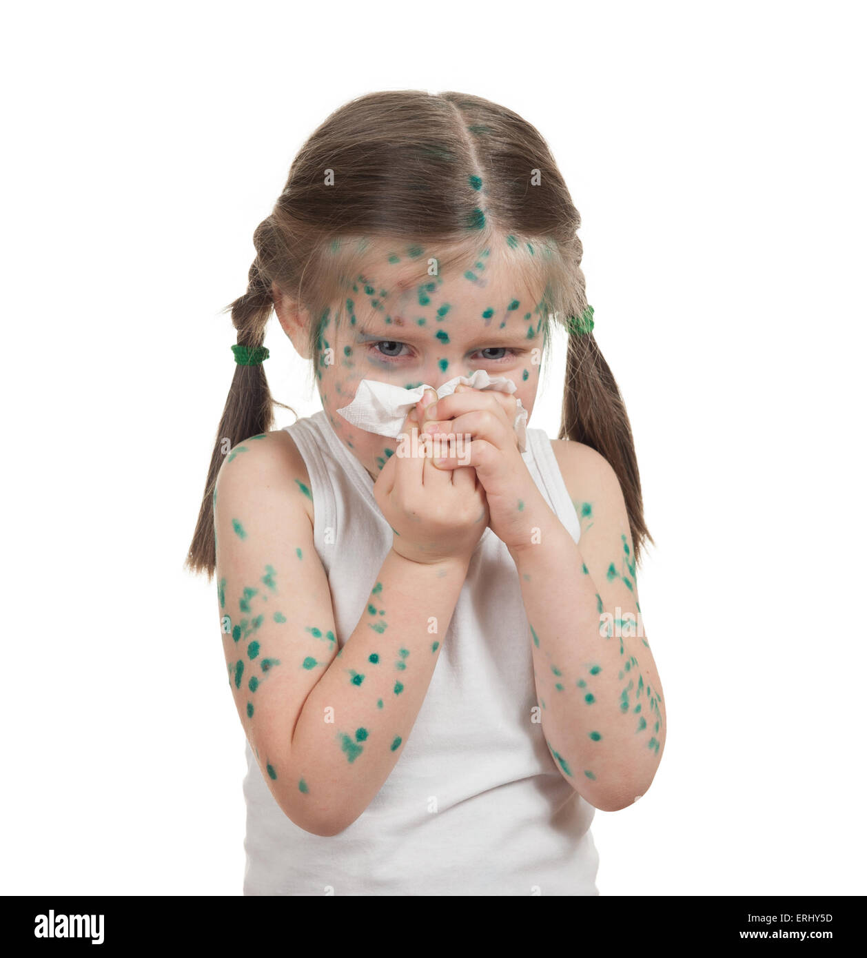 sick child. chickenpox. isolated Stock Photo - Alamy