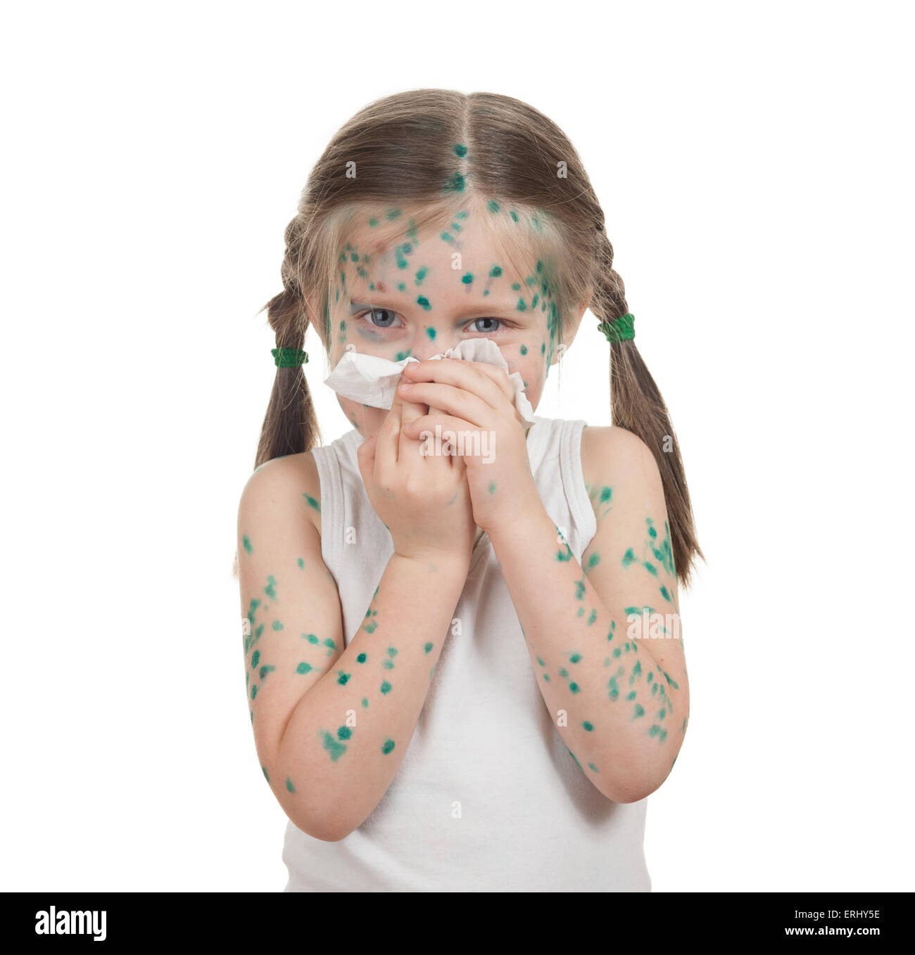 sick child. chickenpox. isolated Stock Photo - Alamy