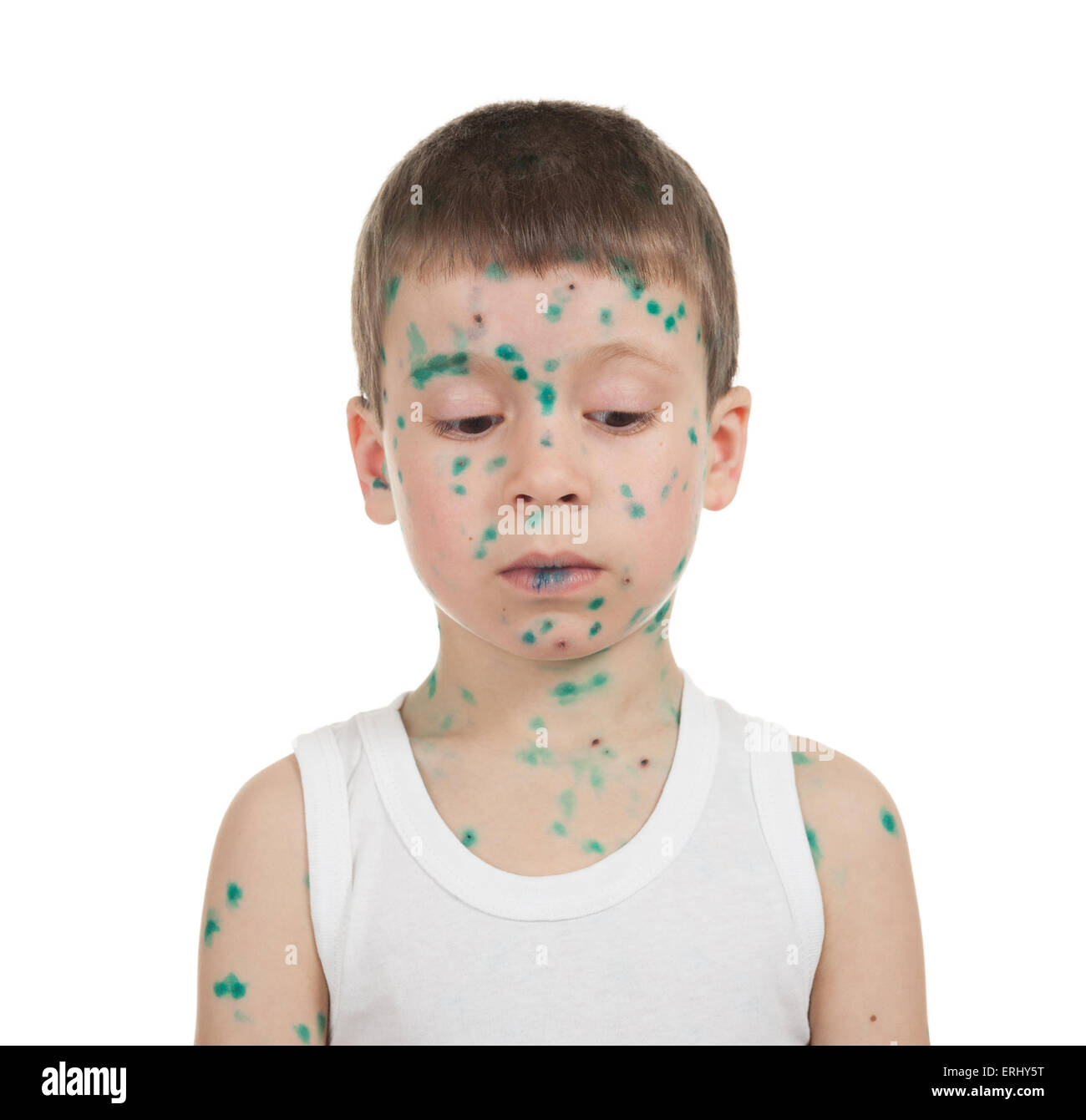 sick child. chickenpox. isolated Stock Photo - Alamy