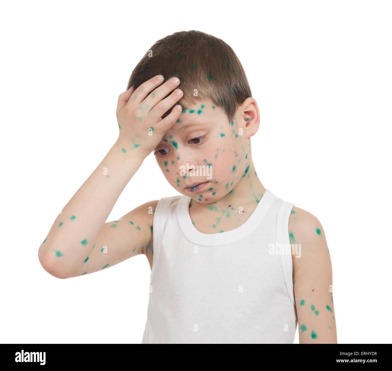 sick child. chickenpox. isolated Stock Photo - Alamy