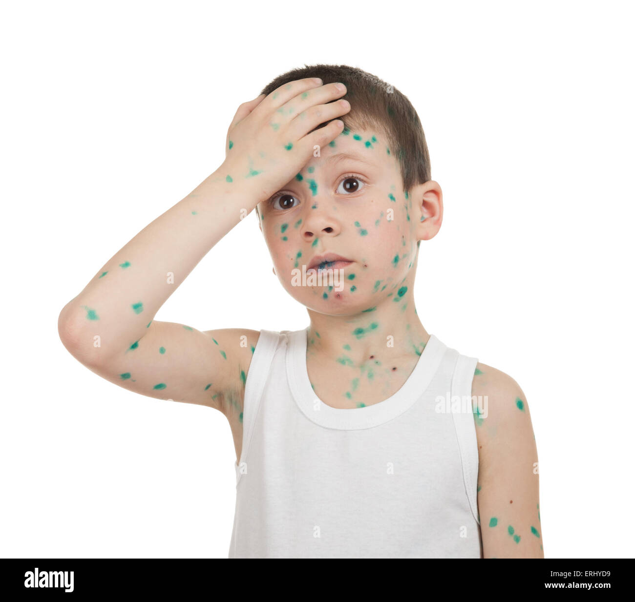 sick child. chickenpox. isolated Stock Photo - Alamy