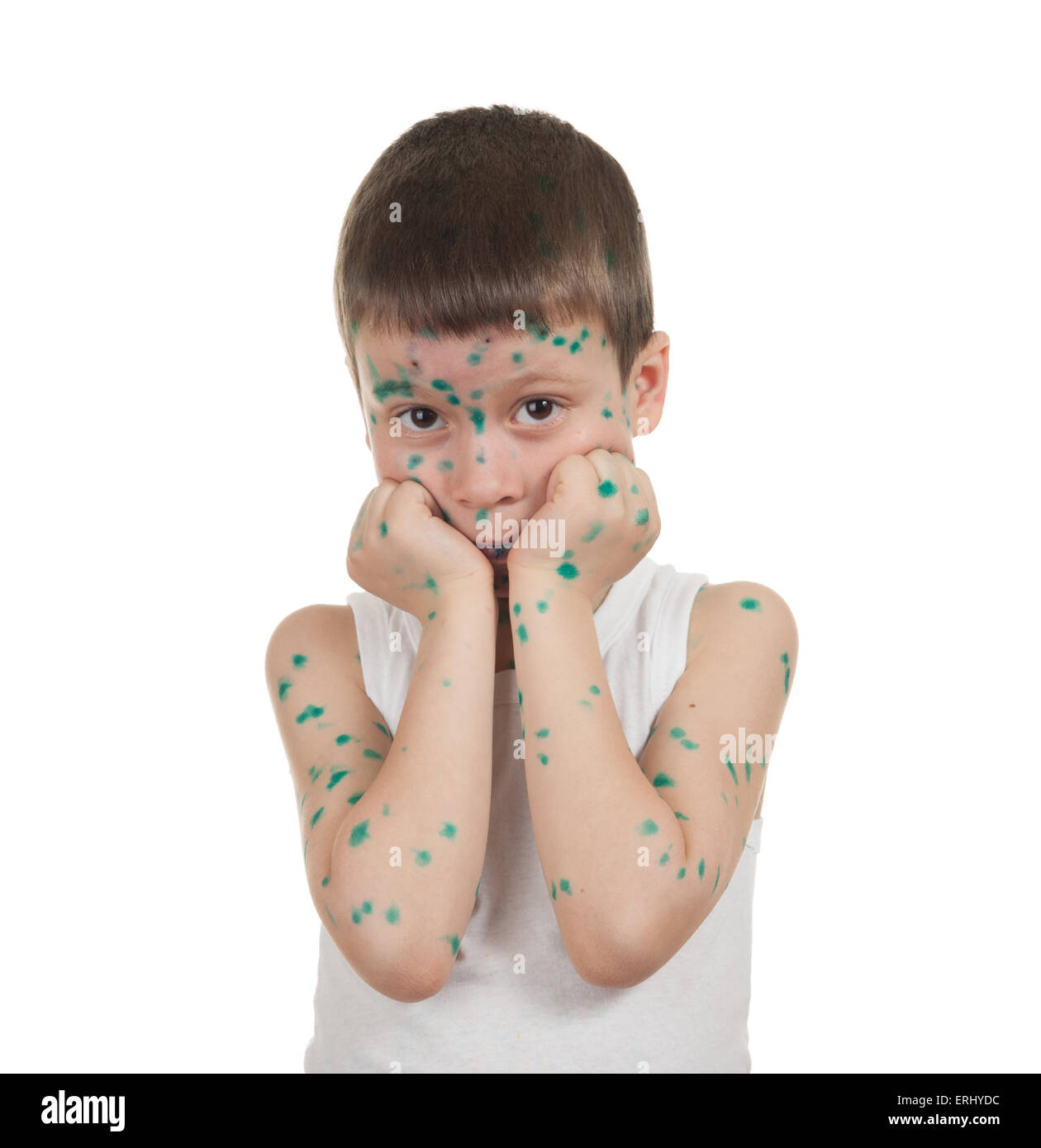 sick child. chickenpox. isolated Stock Photo - Alamy