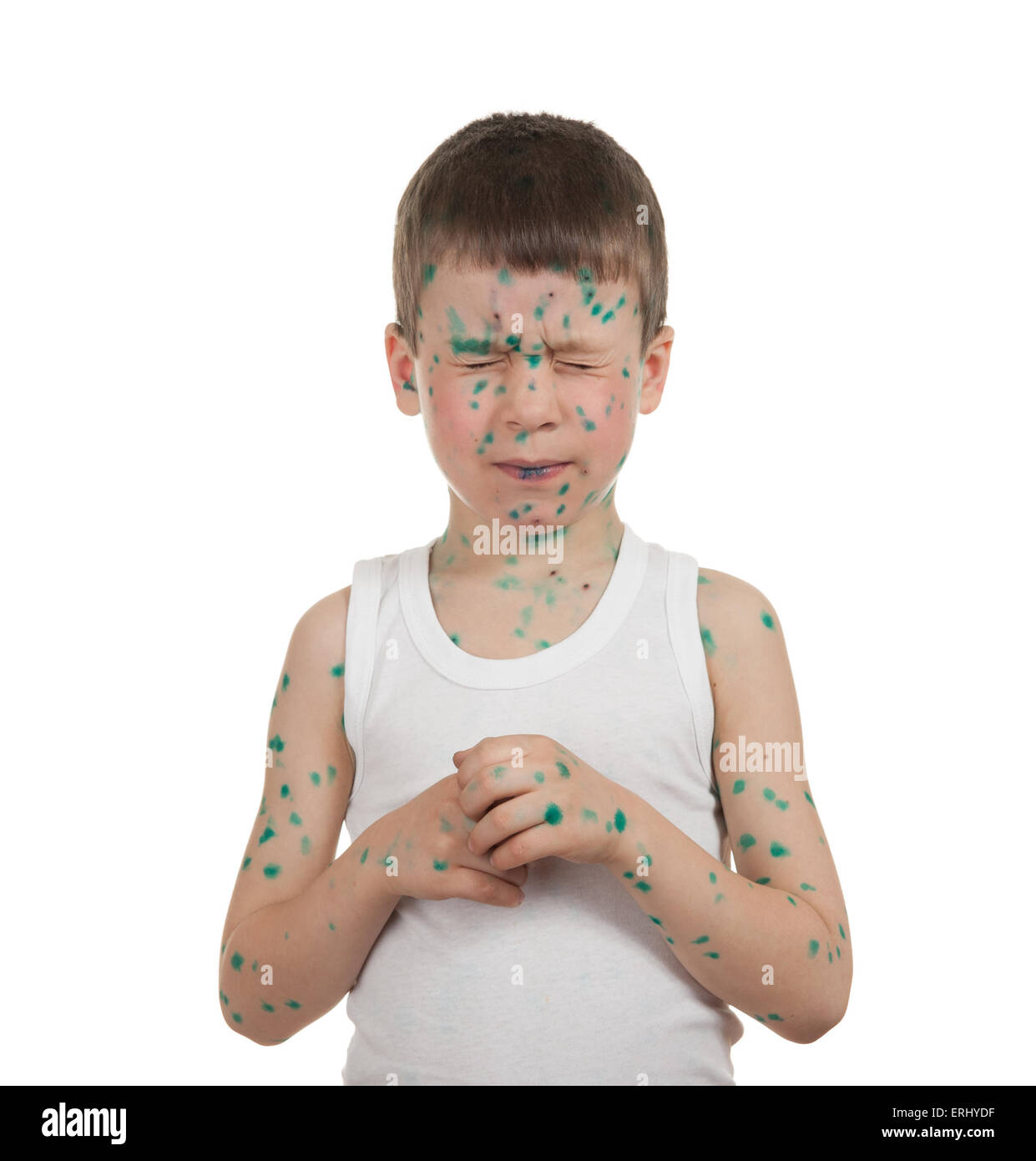 sick child. chickenpox. isolated Stock Photo - Alamy