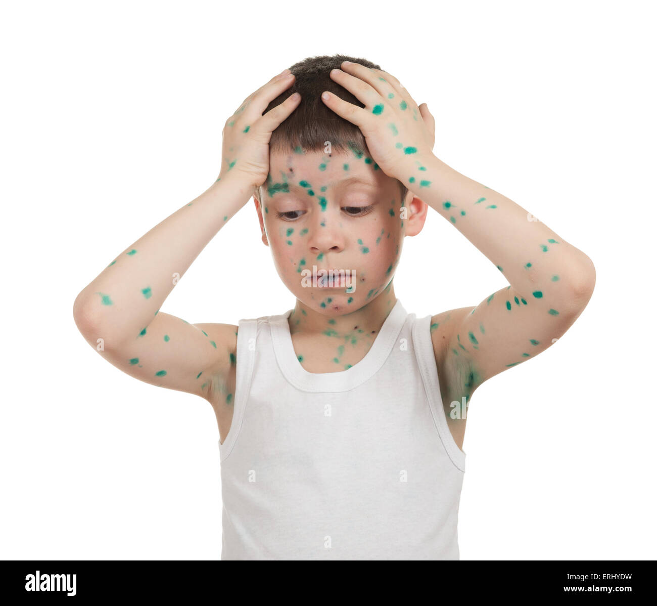 sick child. chickenpox. isolated Stock Photo - Alamy