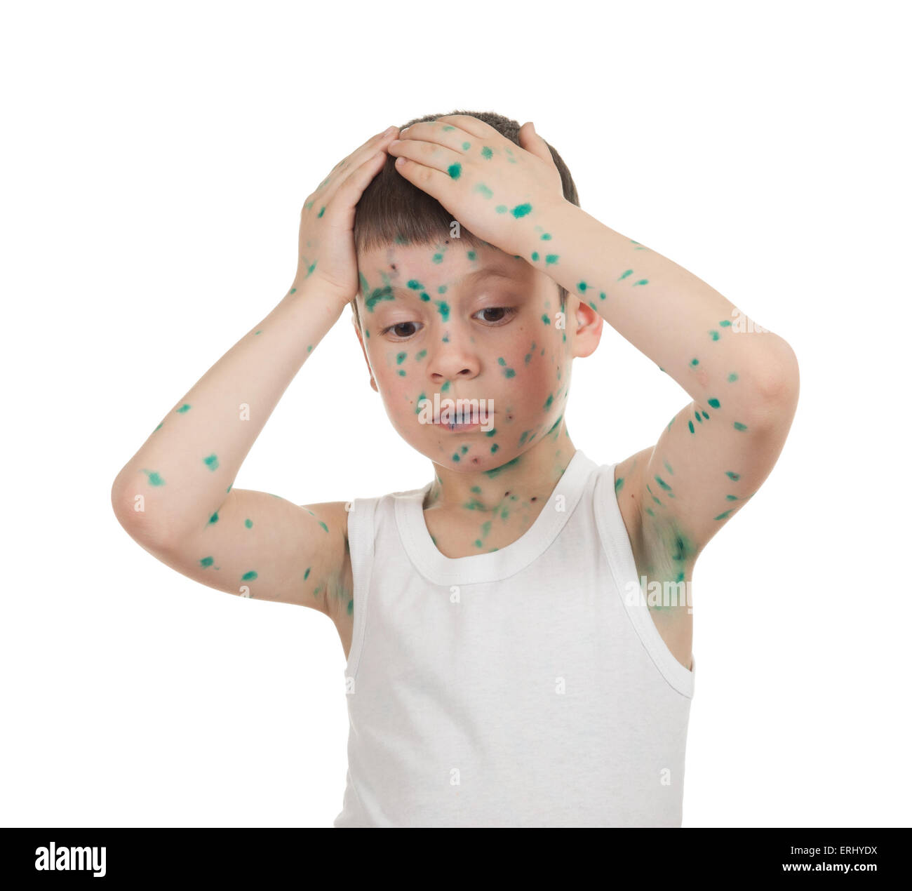 sick child. chickenpox. isolated Stock Photo - Alamy