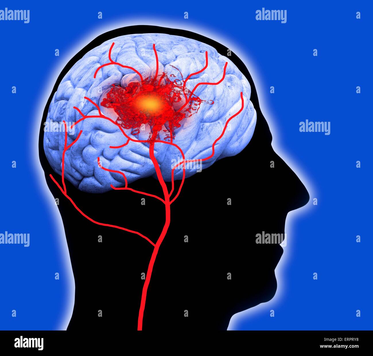 Brain arteries stroke hi-res stock photography and images - Alamy