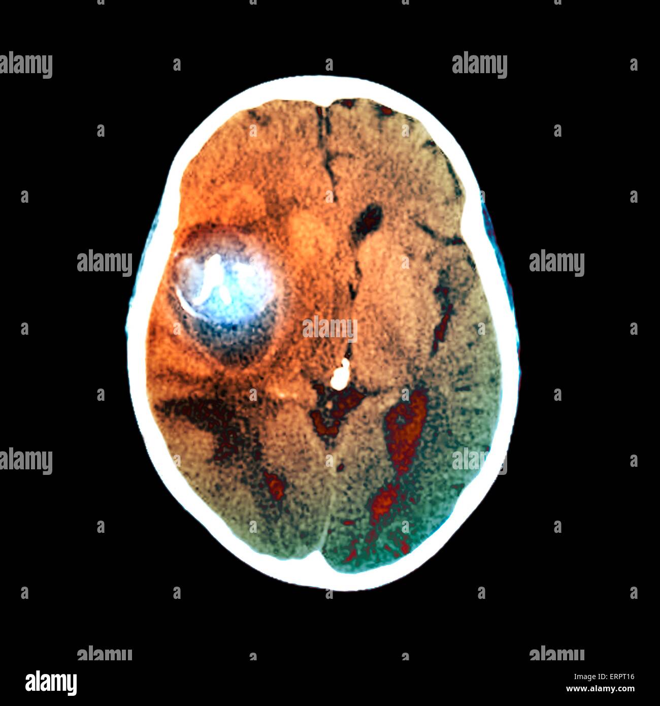 Abnormal ct of brain hi-res stock photography and images - Alamy