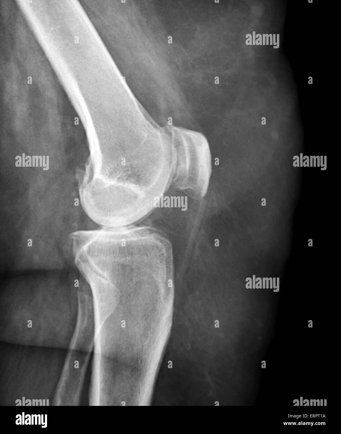 Profile X-ray showing the left knee of a 46 year old obese patient with ...