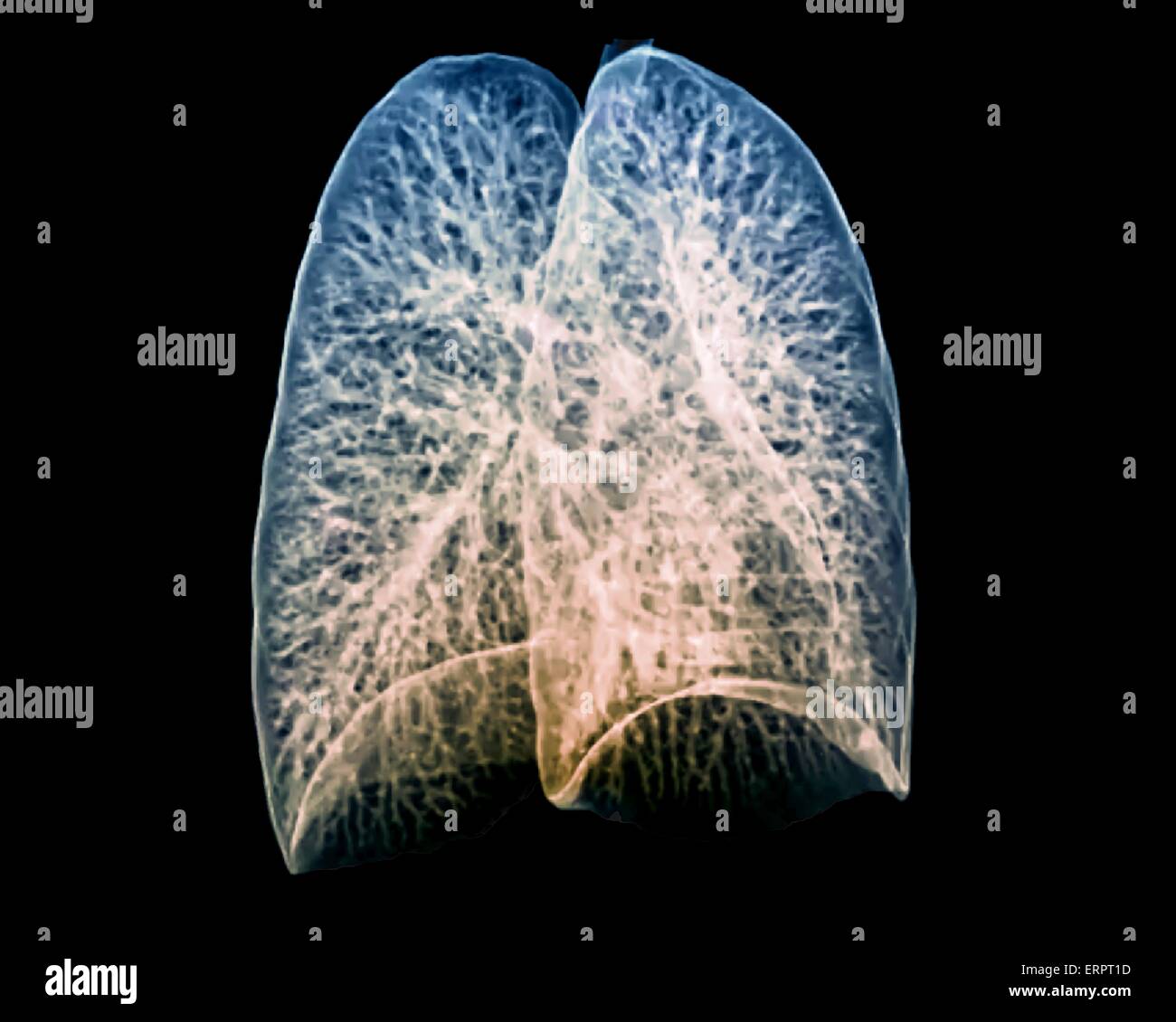 Coloured 3D computed tomography (CT) scan of the healthy lungs of a 30 ...