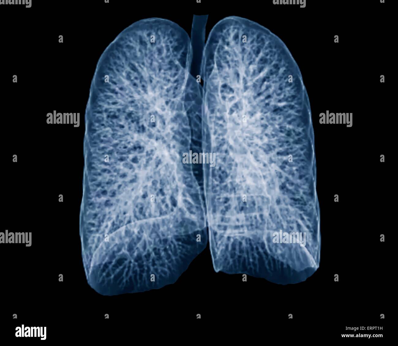 Coloured 3D computed tomography (CT) scan of the healthy lungs of a 30 ...