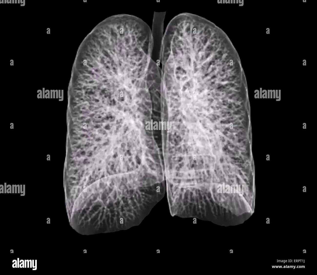 3D computed tomography (CT) scan of the healthy lungs of a 30 year old ...