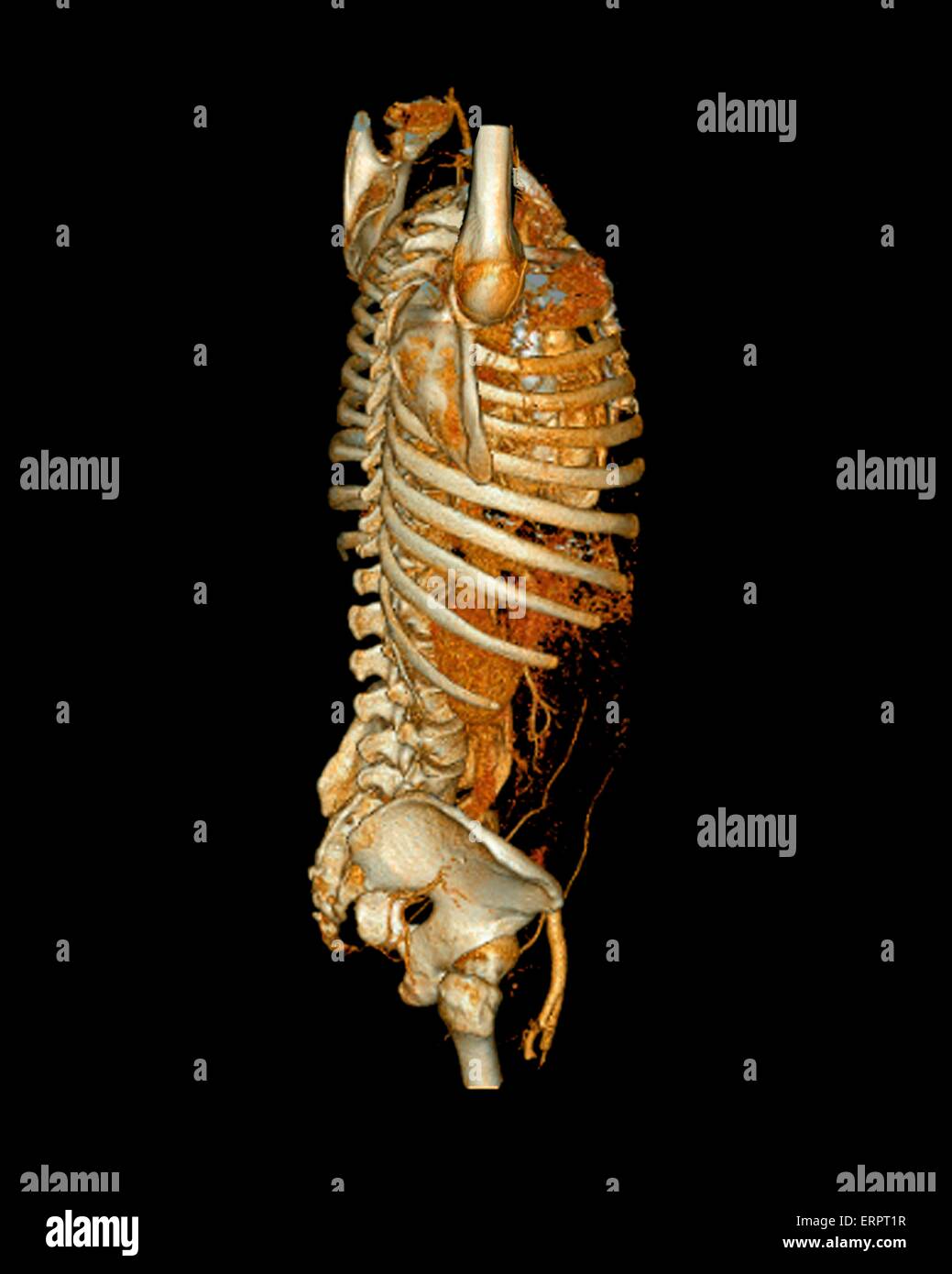 Coloured profile computed tomography (CT) scan of the healthy torso of ... Coloured profile computed tomography (CT) scan of the healthy torso of ...