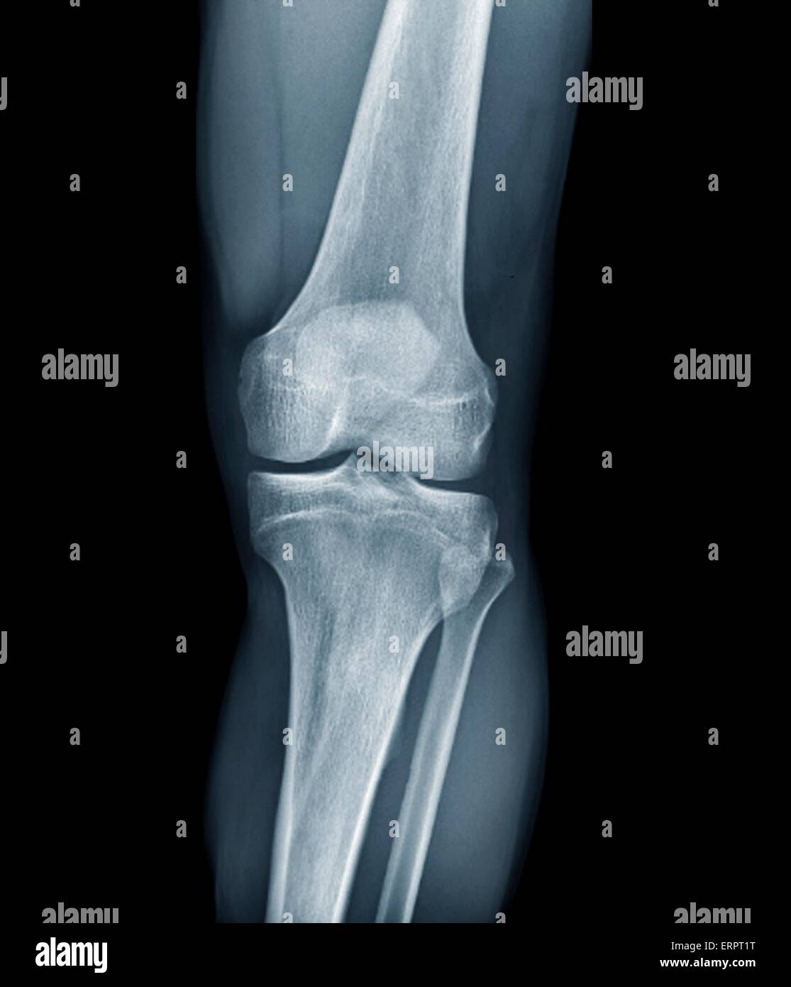 Normal Knee Joint Normal Knee Joint