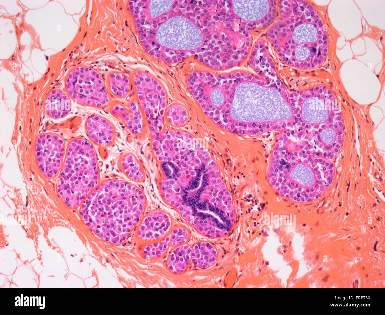 Ductal carcinoma in situ of the breast, light micrograph of a section ...