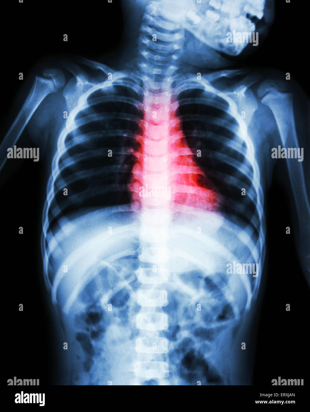 Heart X Ray High Resolution Stock Photography and Images - Alamy