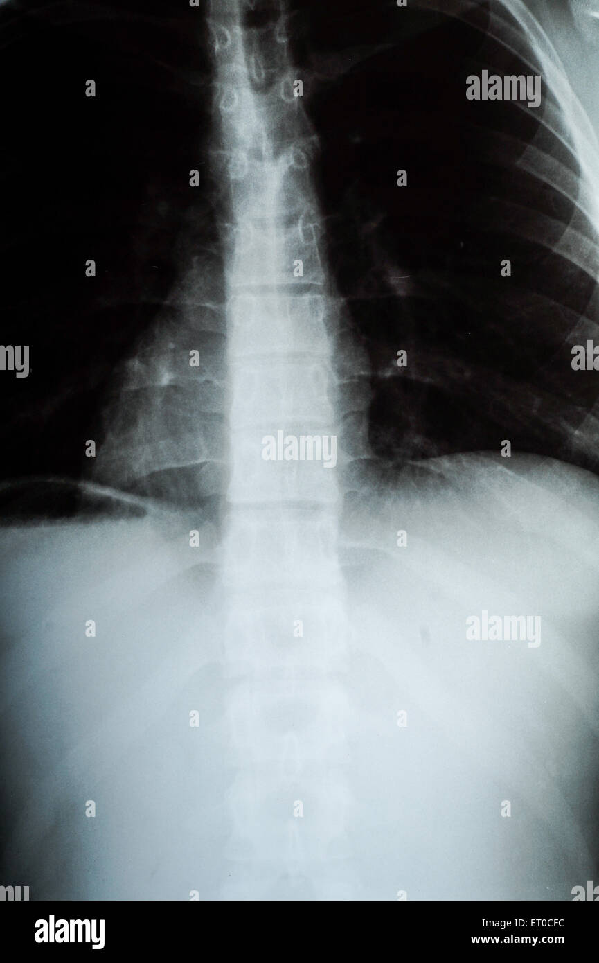 X-Ray Image Of Human Chest for a medical exam by the Doctors Stock ...