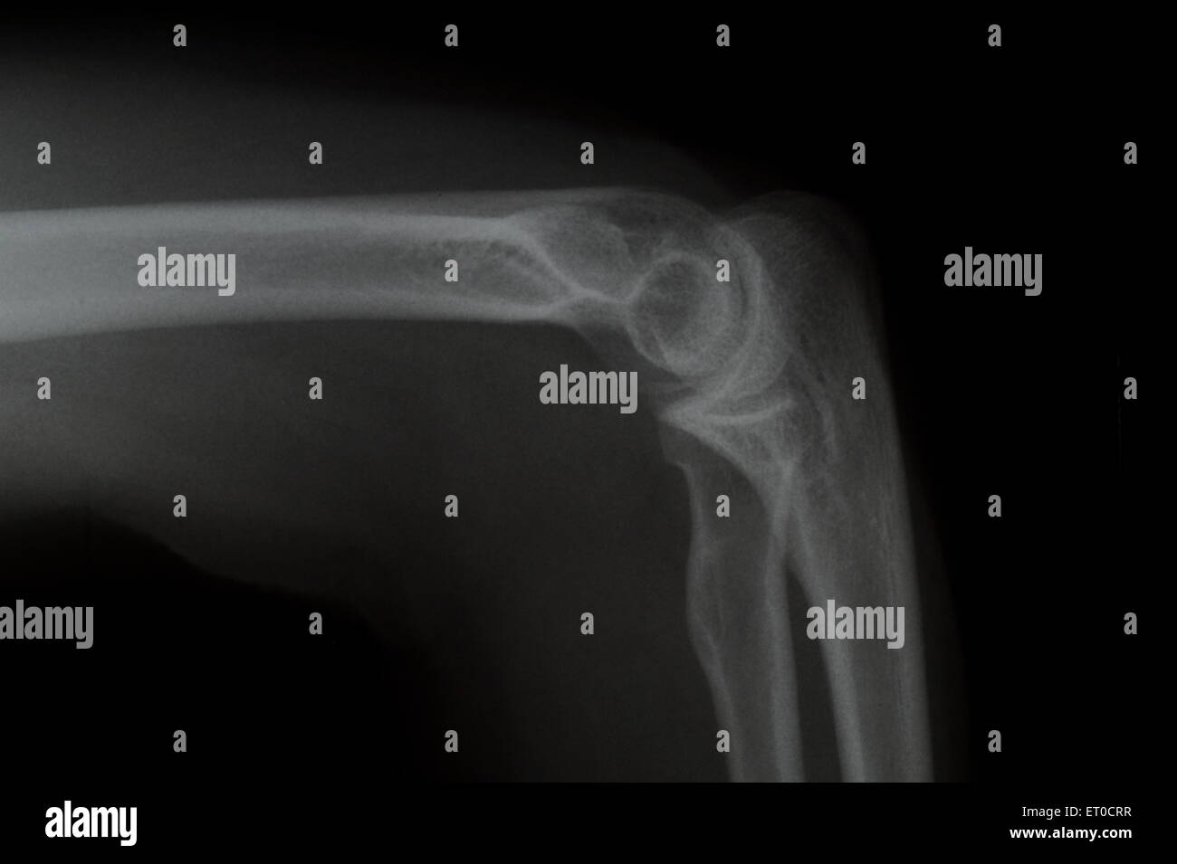 Elbow x ray hi-res stock photography and images - Alamy