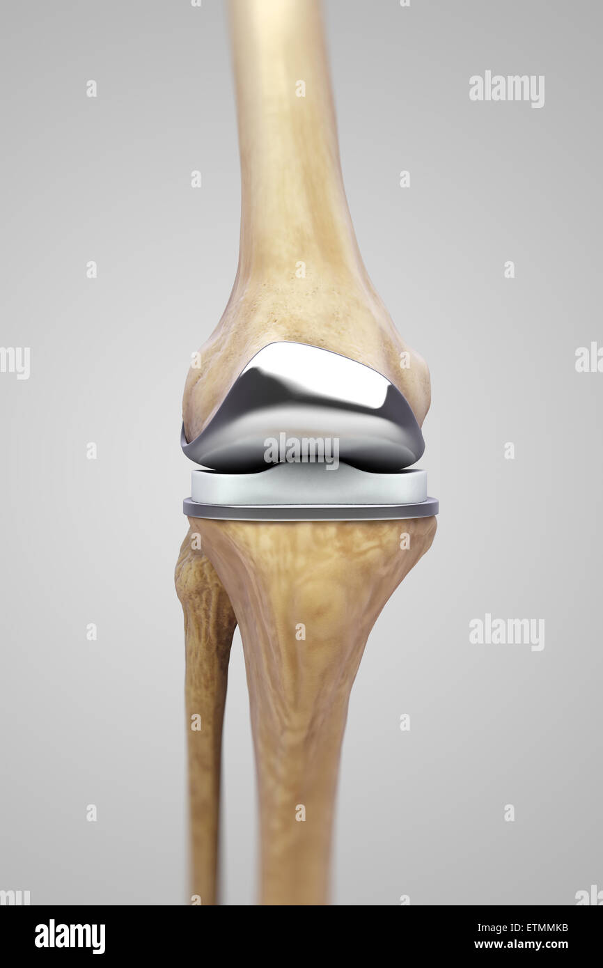 Artificial Knee Replacement Stock Photos & Artificial Knee Replacement ...