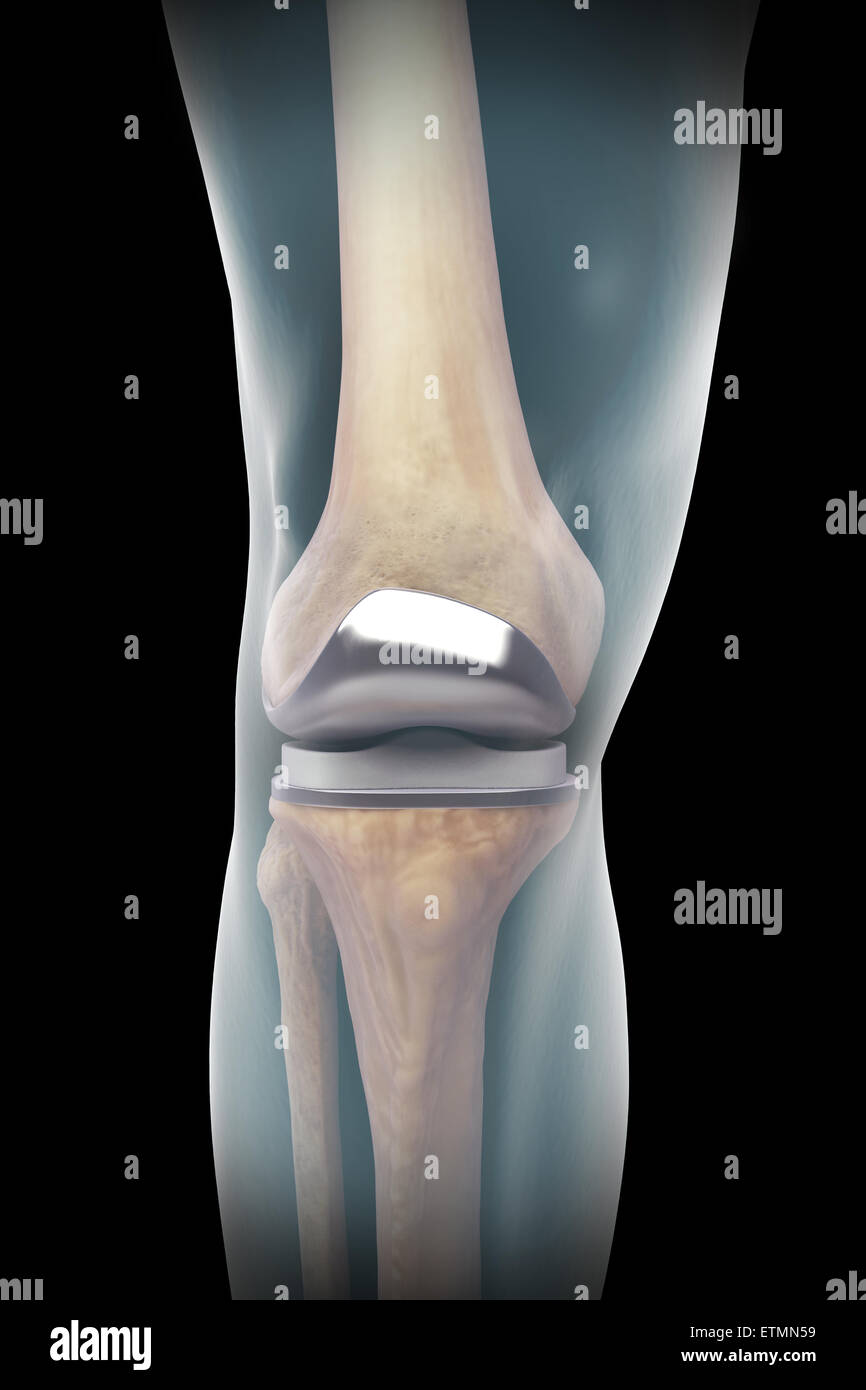 Knee implant hi-res stock photography and images - Alamy