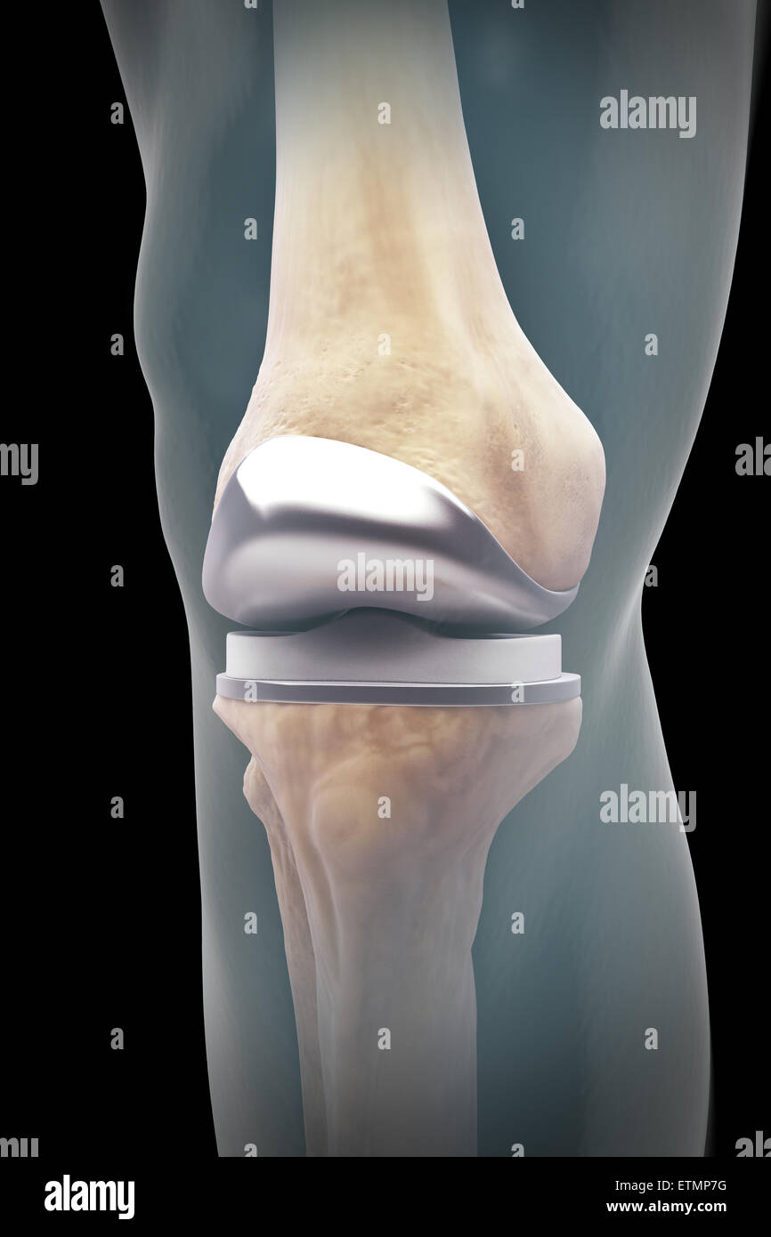 Artificial Knee Replacement Stock Photos & Artificial Knee Replacement ...