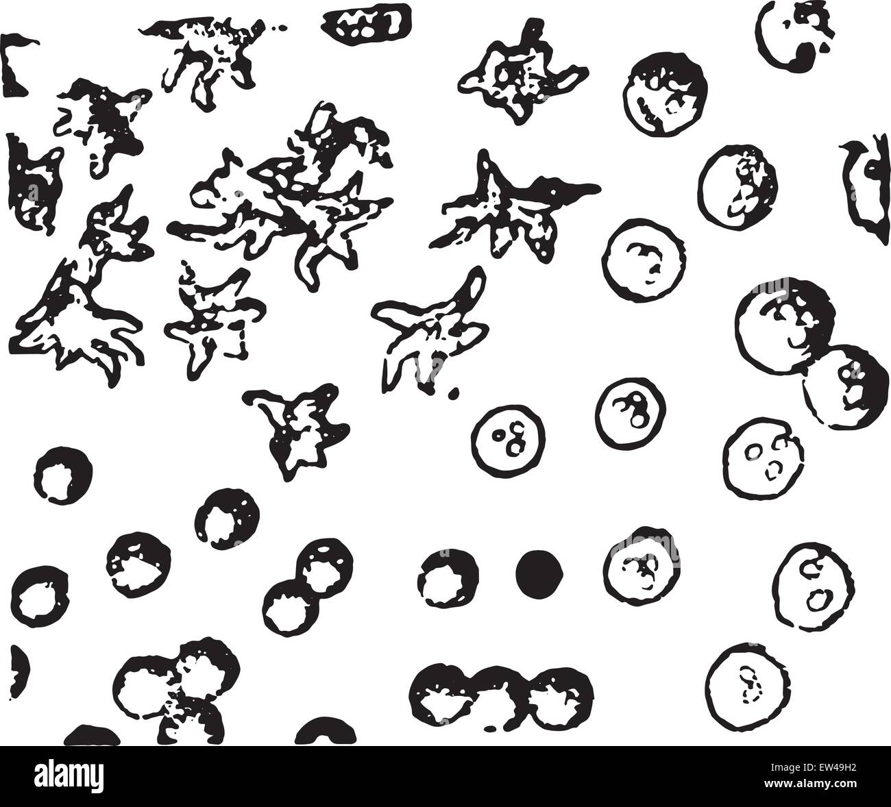 Pus-cells in urine, vintage engraved illustration Stock Vector Image ...