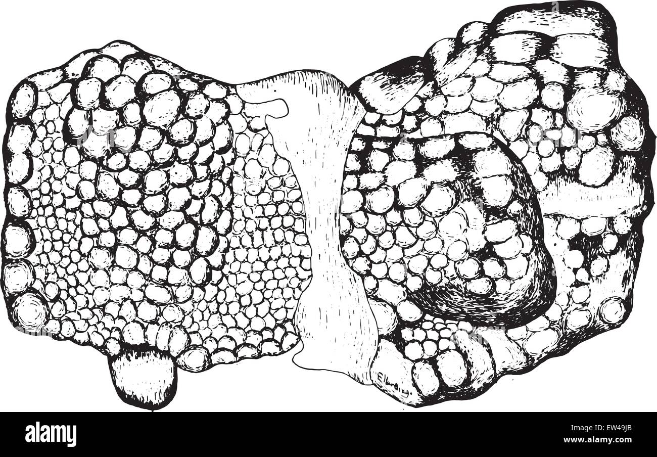 Liver cirrhosis drawing hi-res stock photography and images - Alamy
