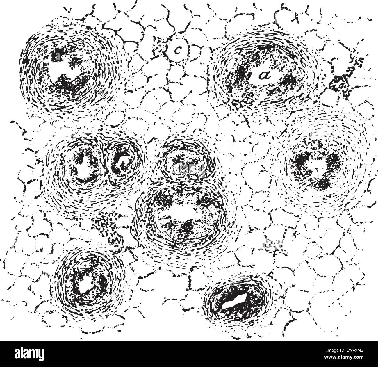 Bronchitis drawing hi-res stock photography and images - Alamy