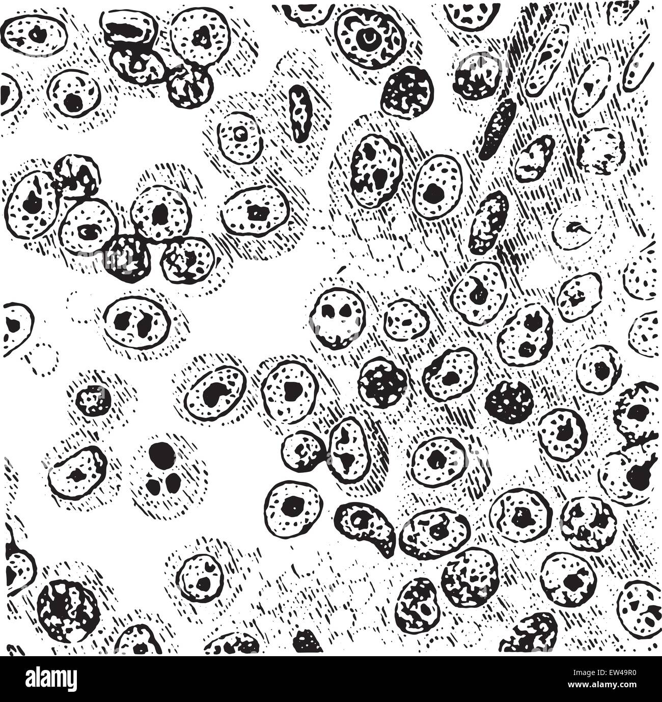 Round cell sarcoma, vintage engraved illustration Stock Vector Image ...