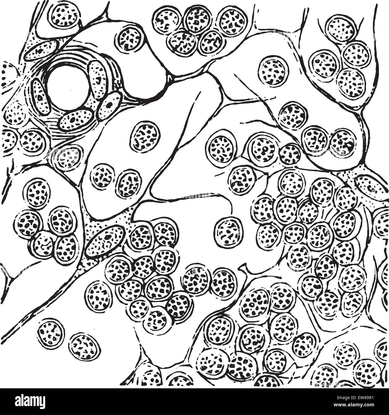 Round cell sarcoma of a lymphatic gland, vintage engraved illustration ...