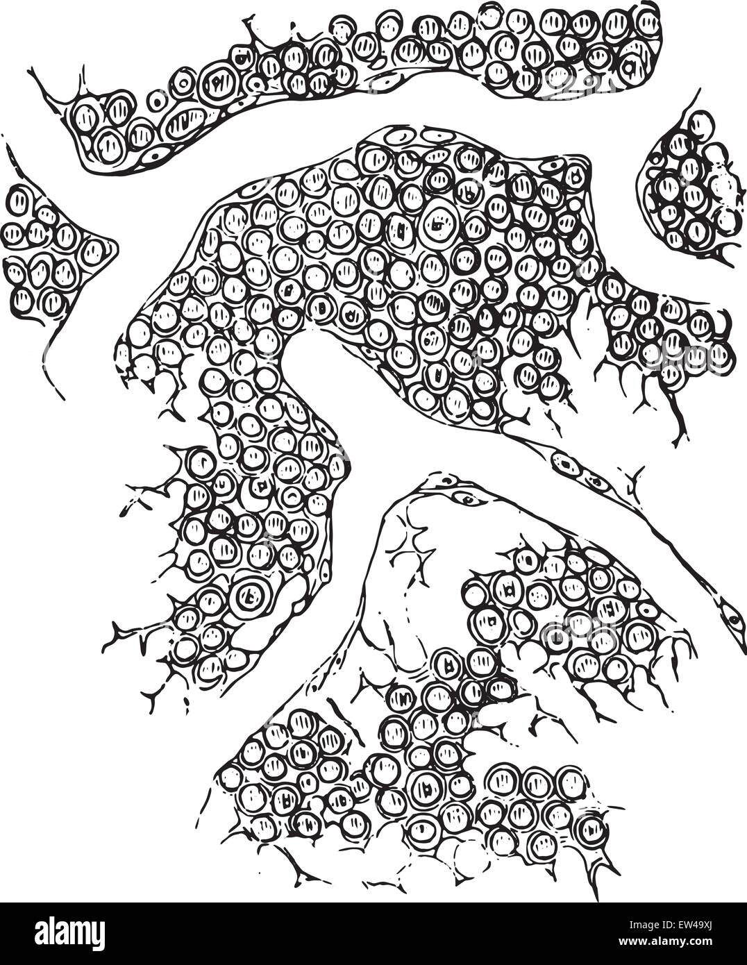 Round cell sarcoma, vintage engraved illustration Stock Vector Image ...