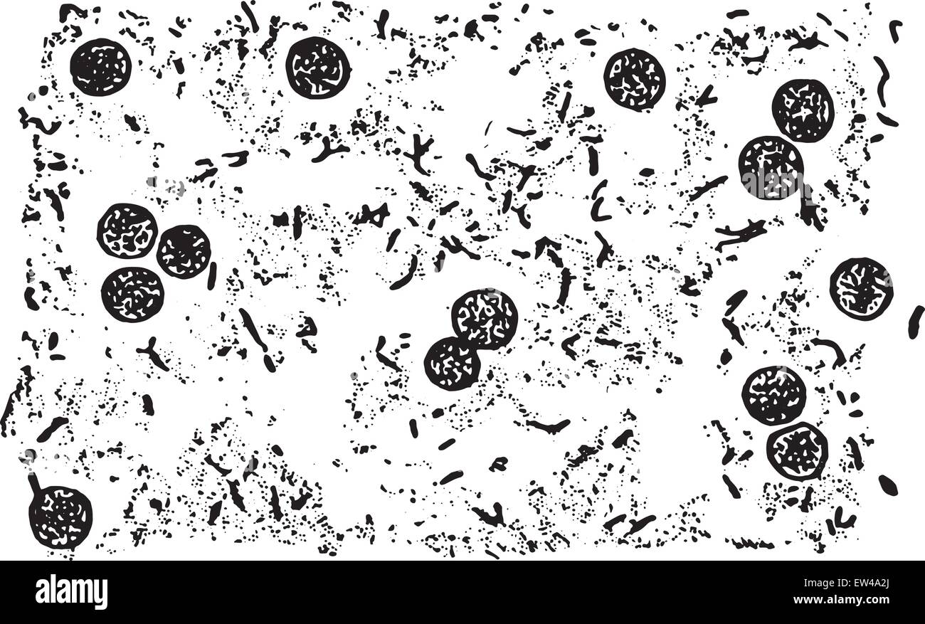 Tuberculosis drawing hi-res stock photography and images - Alamy