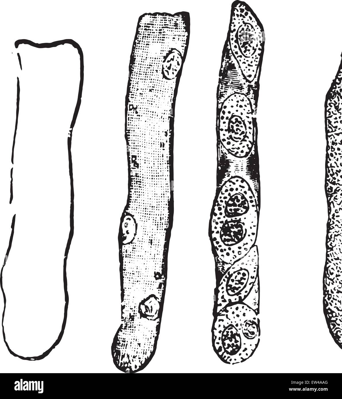 Hyaline cast, vintage engraved illustration Stock Vector Image & Art ...