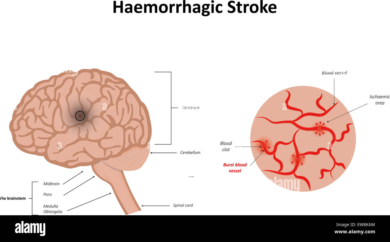 Hemorrhagic Stroke Stock Photo: 84398572 - Alamy