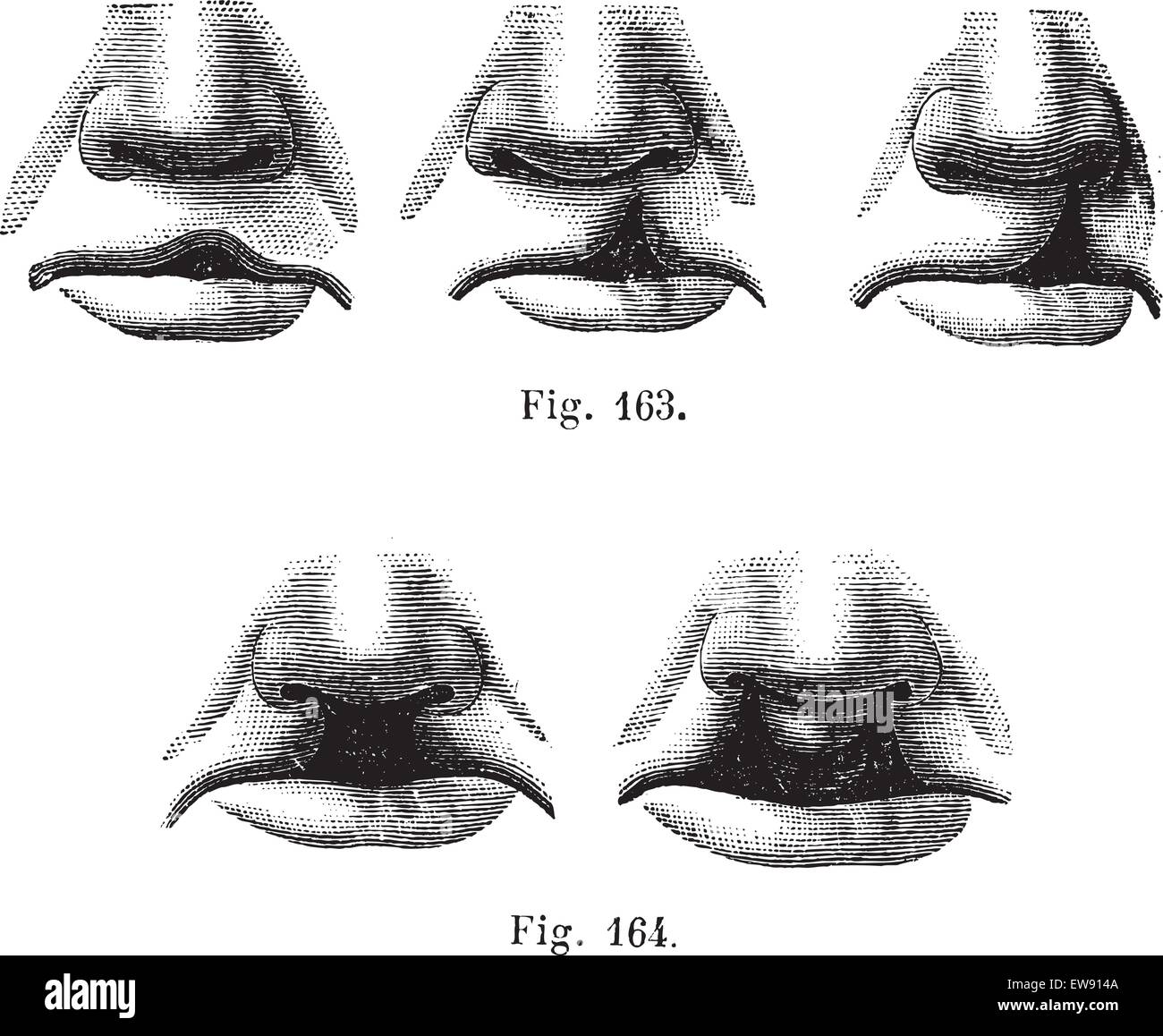 Fig. 163. Degrees of cleft lip simple, Fig. 164. Cleft lip double ...
