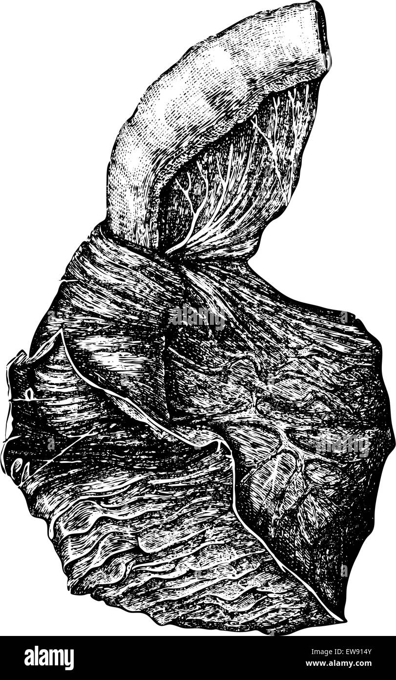 Intussusception of the Intestine, vintage engraved illustration. Usual ...