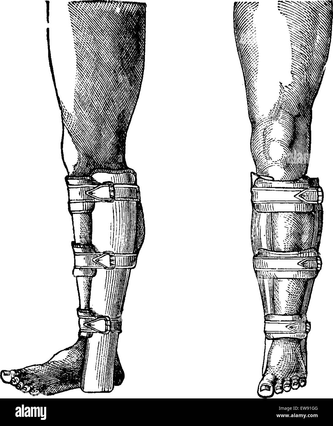 Leg splint hi-res stock photography and images - Alamy