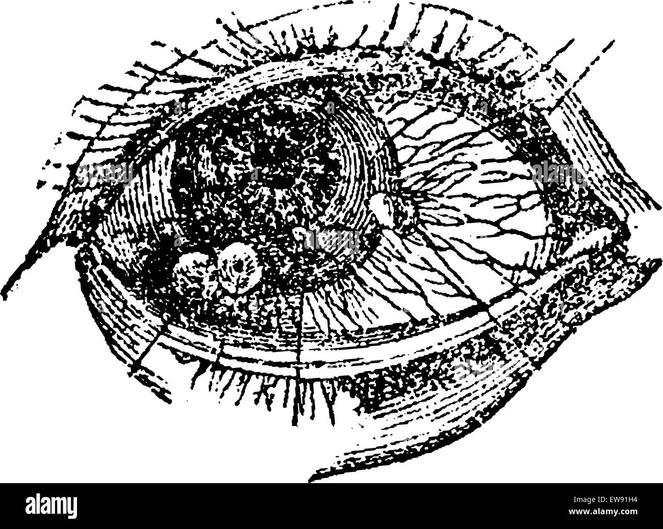 Eye with Pustular Conjunctival Keratitis, vintage engraved illustration ...