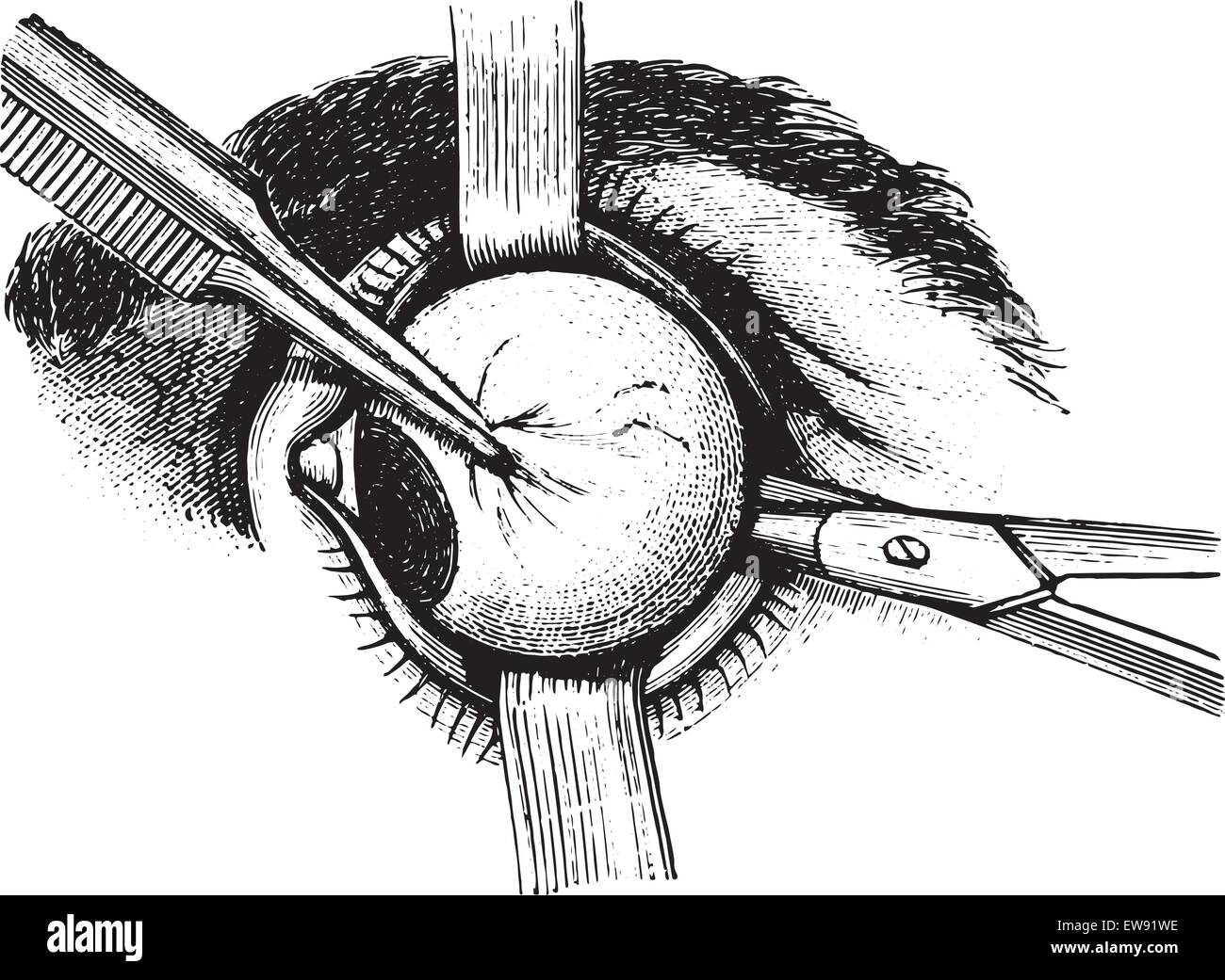 Extirpation of the eye, vintage engraved illustration. Usual Medicine ...