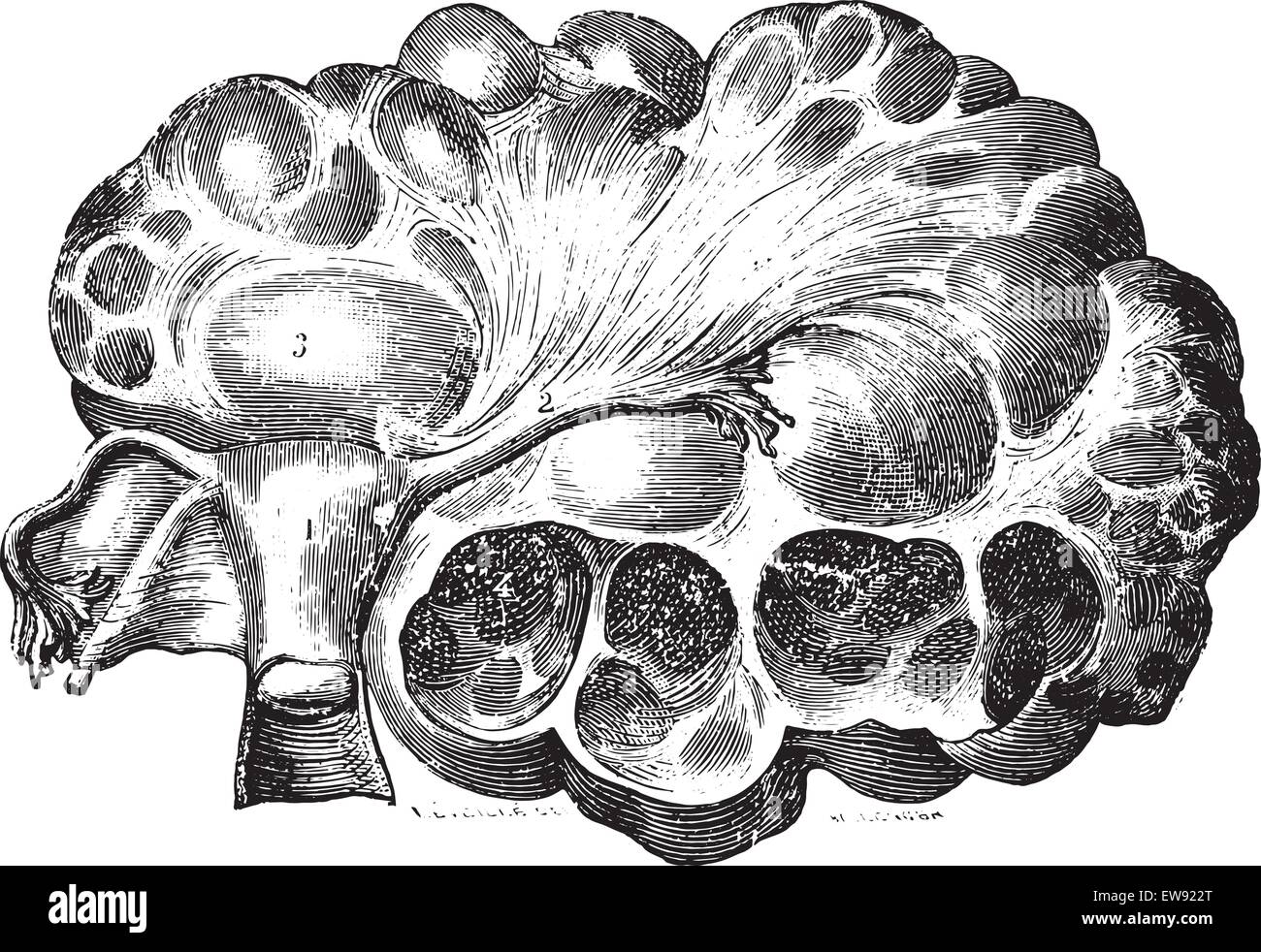 Multilocular Cyst Of The Left Ovary Vintage Engraved Illustration
