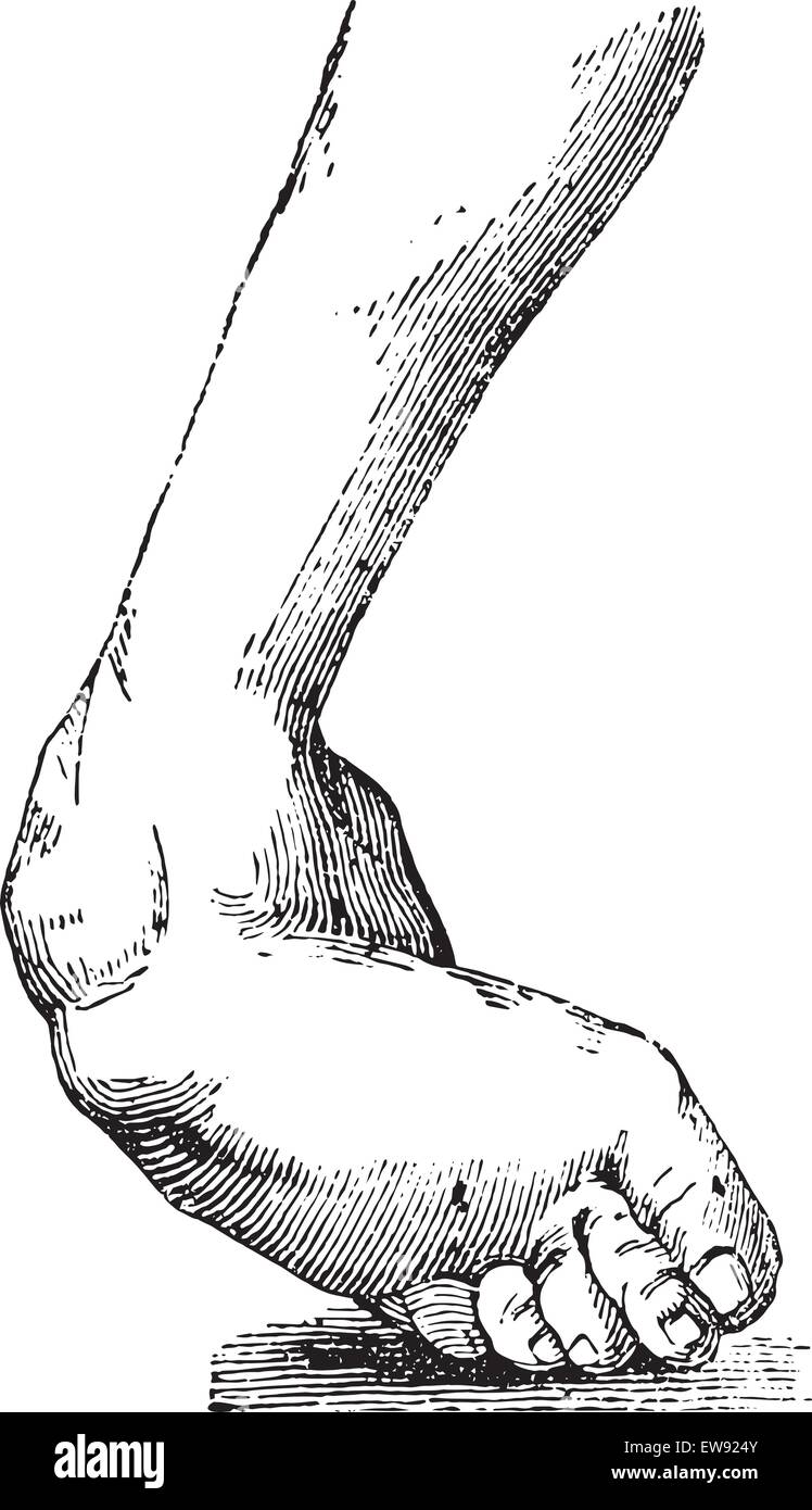 Clubfoot hi-res stock photography and images - Alamy