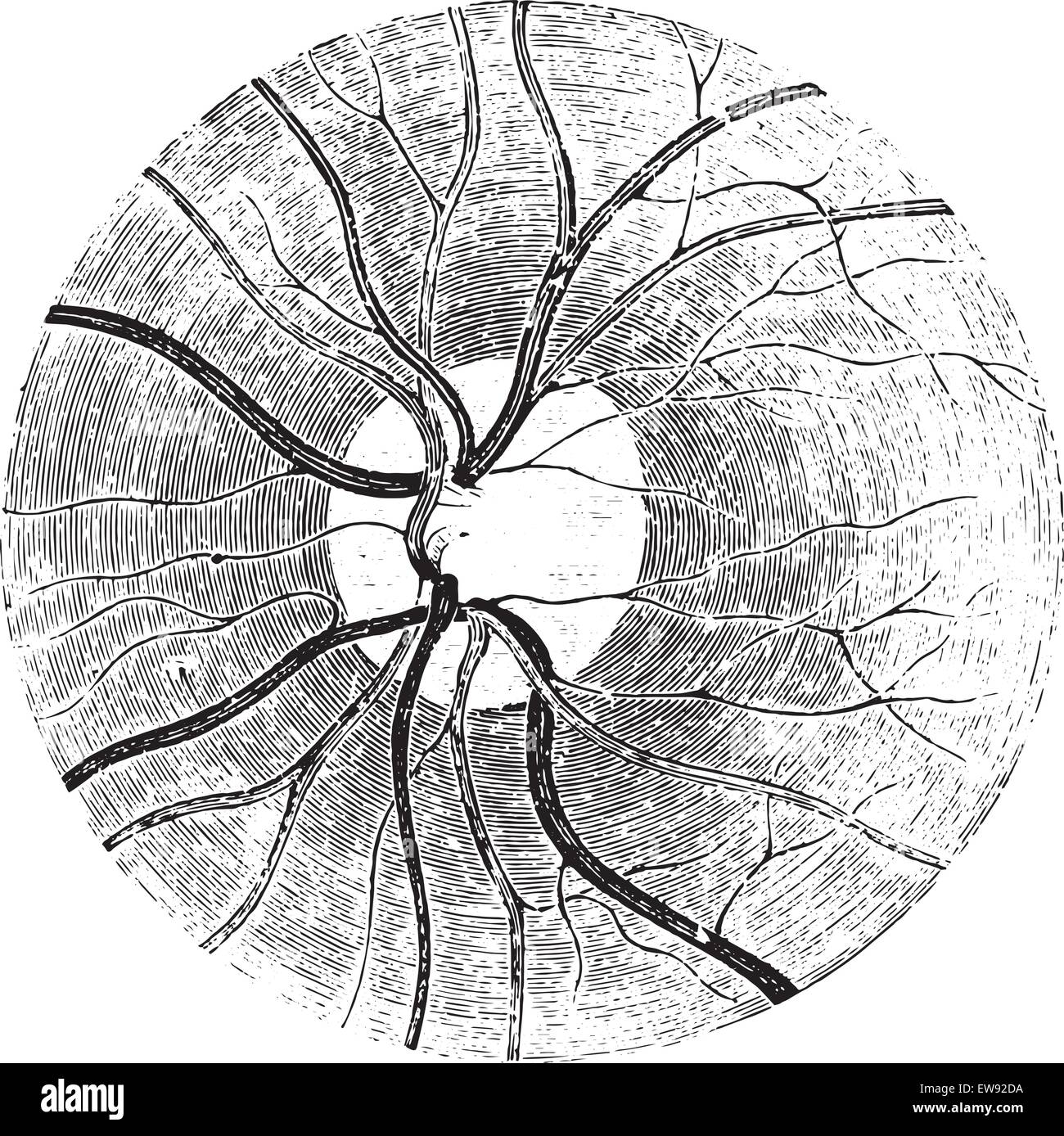 Papilledema hi-res stock photography and images - Alamy