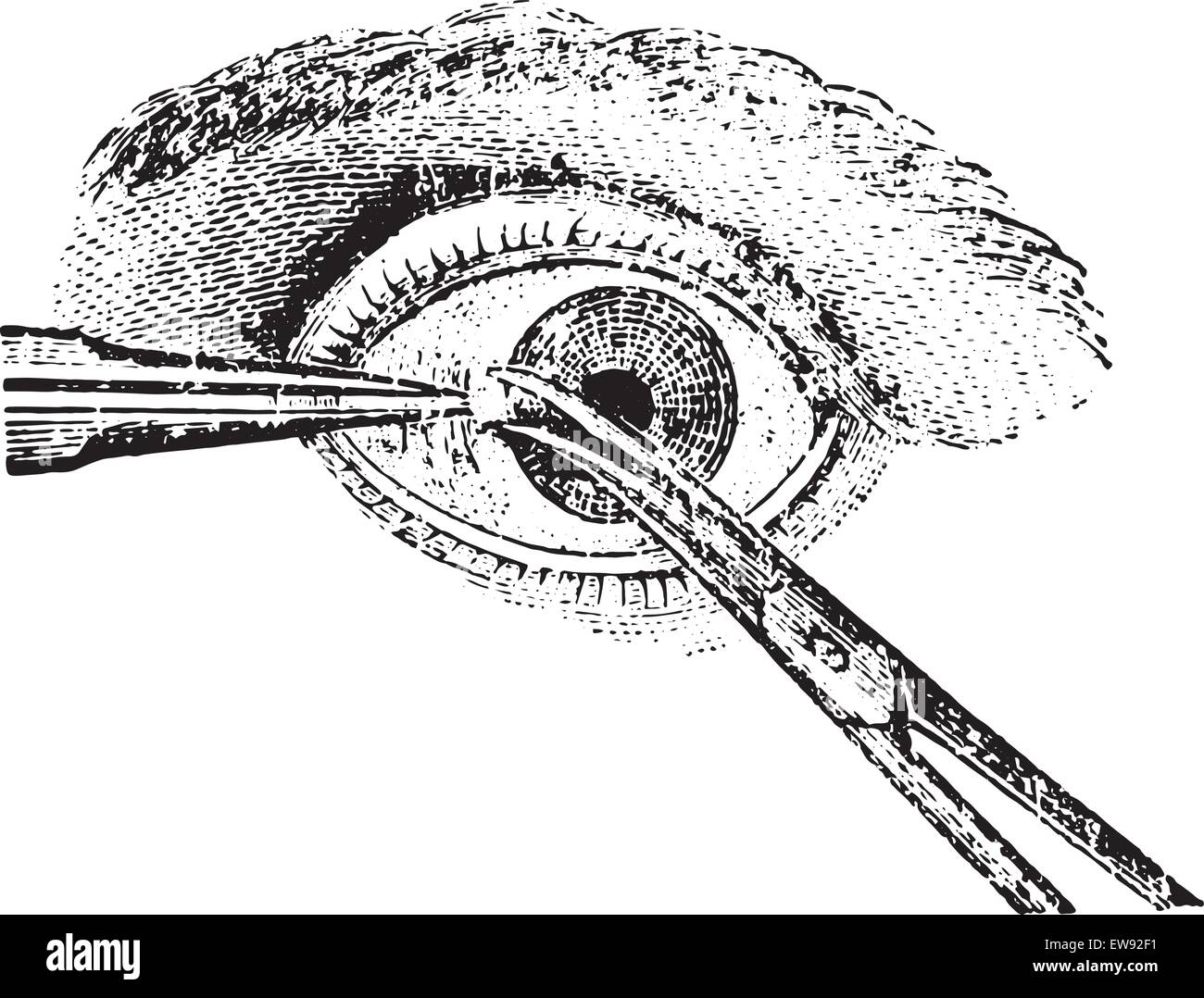 Strabismus vector vectors hi-res stock photography and images - Alamy