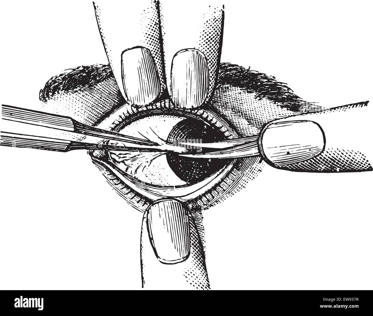 Excision of pterygium, vintage engraved illustration. Usual Medicine ...