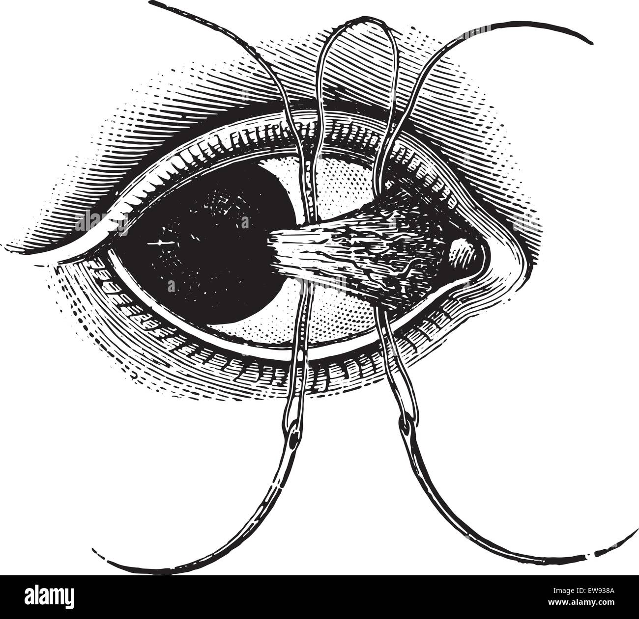 Ligation of pterygium, vintage engraved illustration. Usual Medicine ...