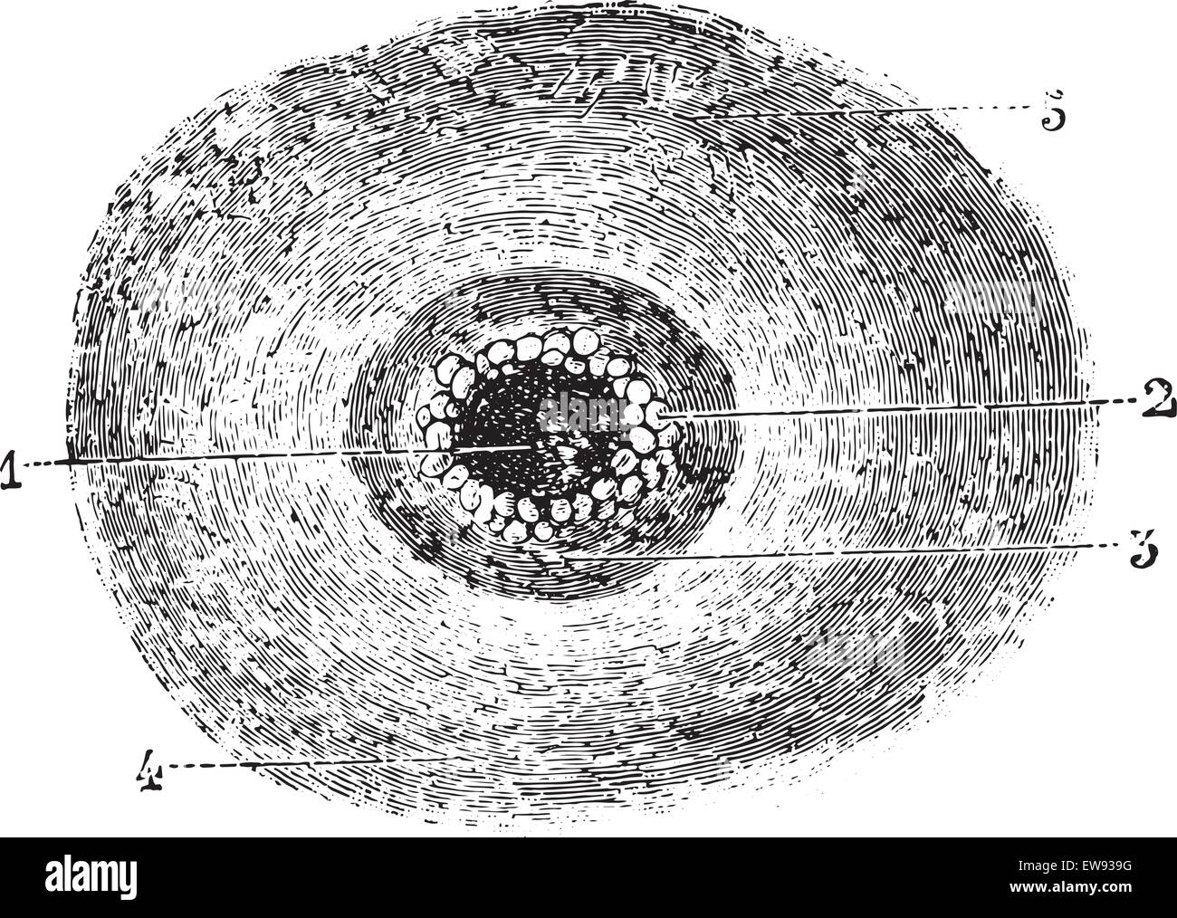 Malignant pustule hi-res stock photography and images - Alamy