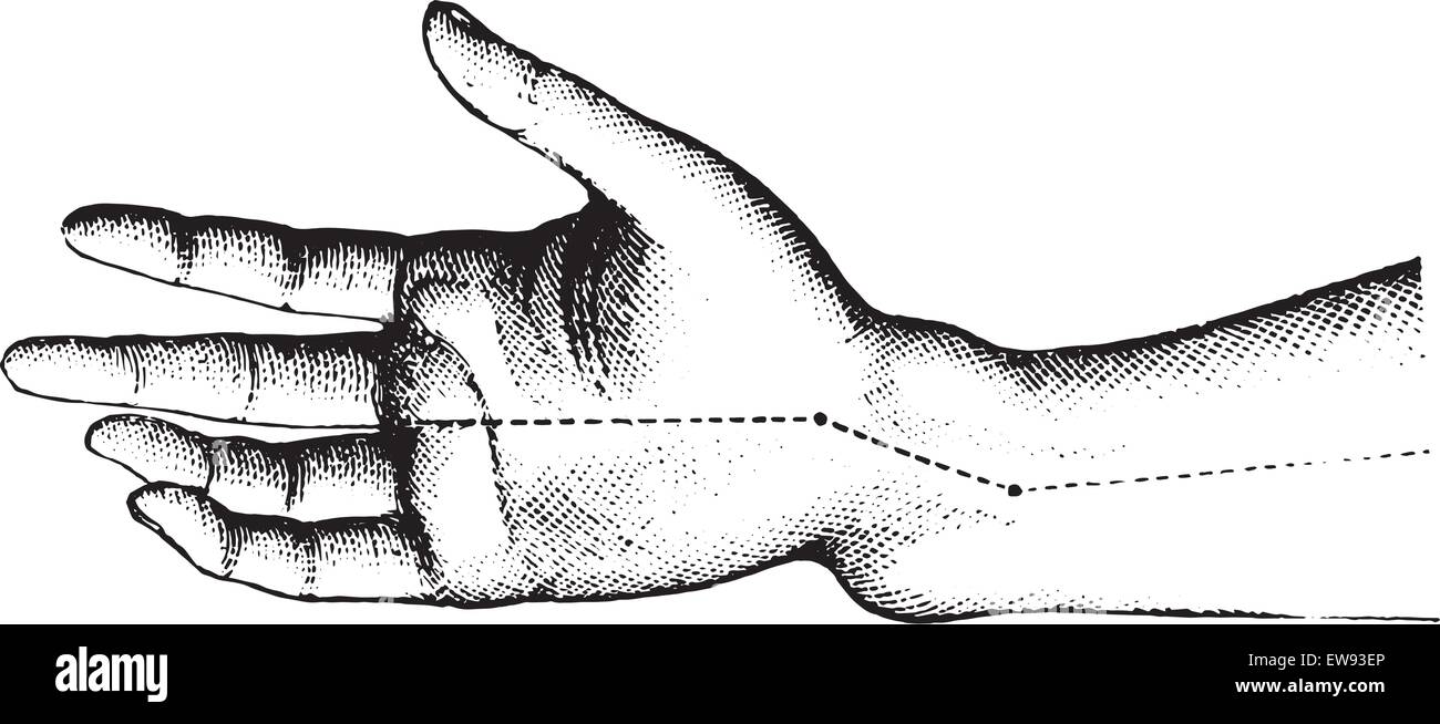 Distal radius fracture hi-res stock photography and images - Alamy