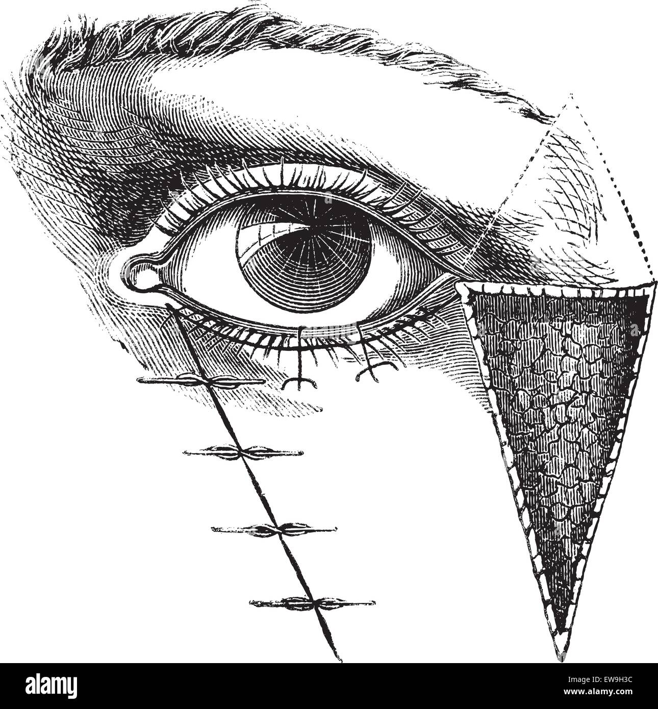 Blepharoplasty vector vectors hi-res stock photography and images - Alamy